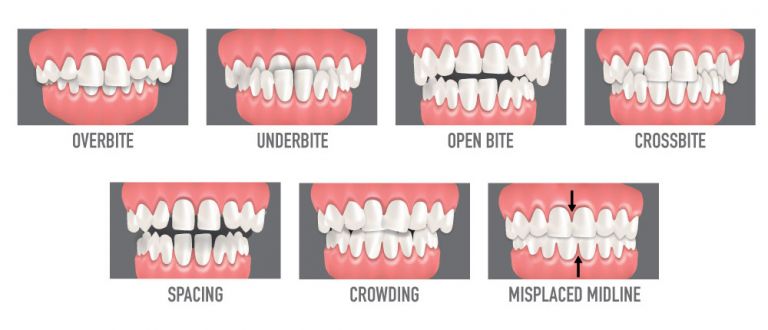 Orthodontics - Winston Churchill Dental